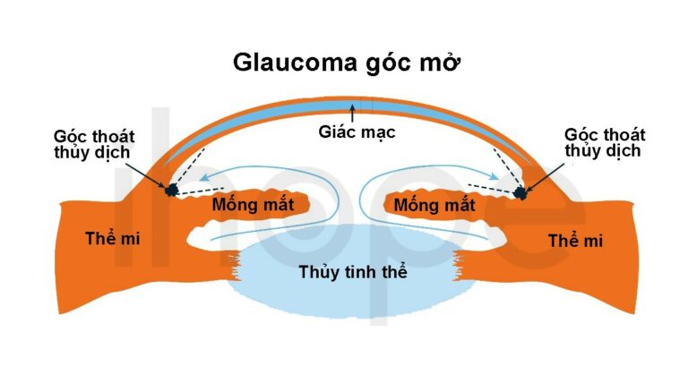 Các loại bệnh glaucoma phổ biến – ihope