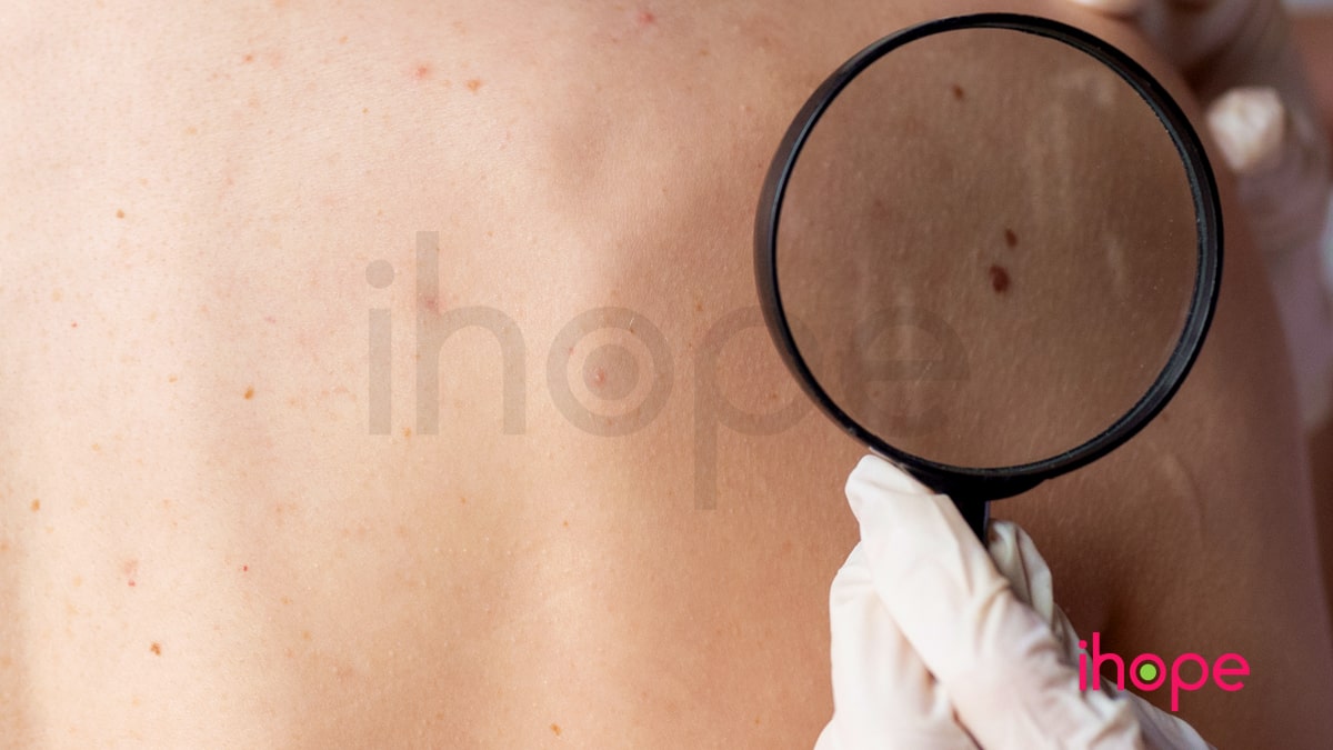 Bệnh ban đỏ dạng ichthyosiform bẩm sinh không có bọng nước – ihope