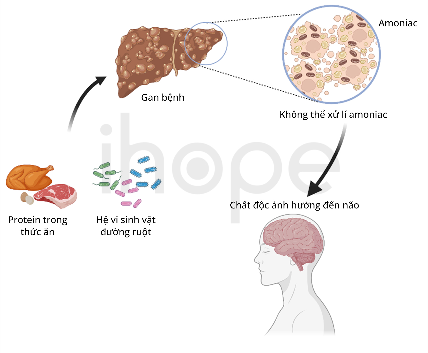 Thiếu ornithine translocase – ihope